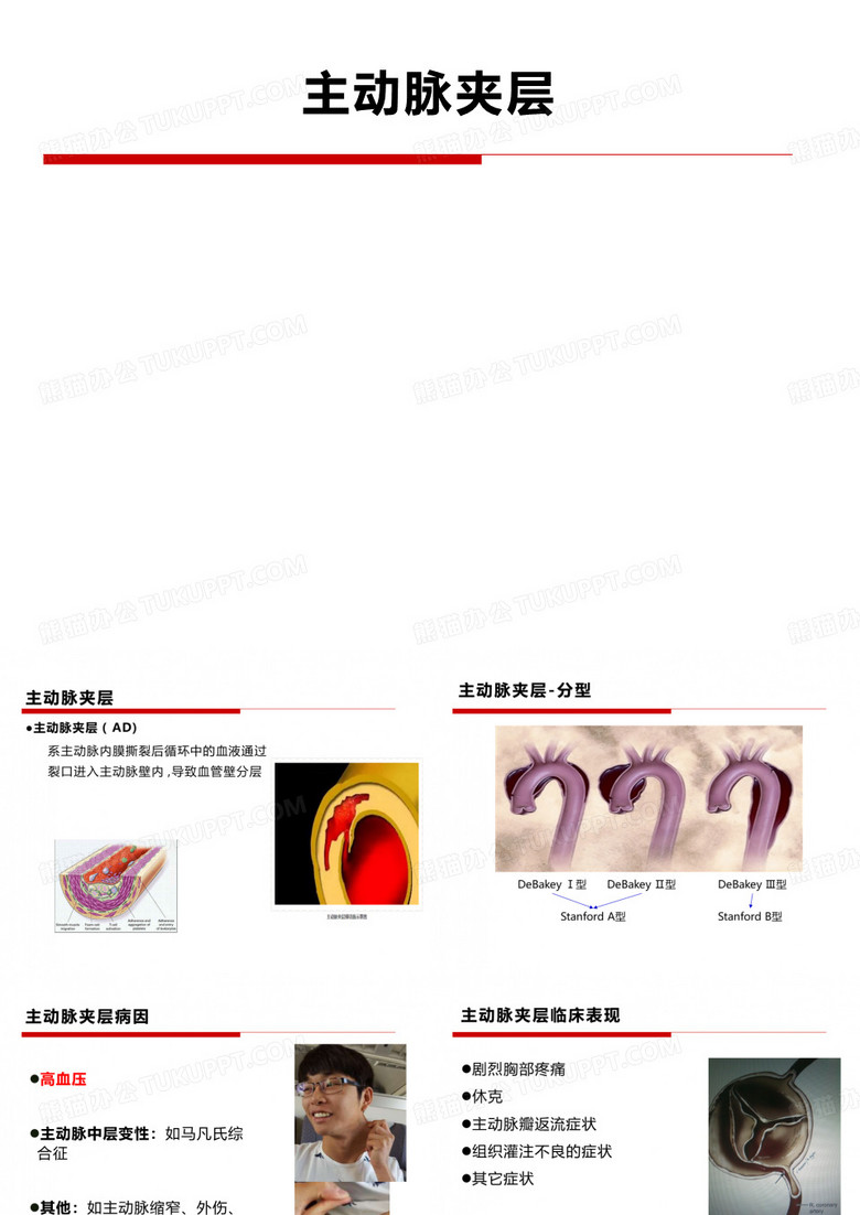 主动脉夹层PPT模板下载 编号ldgeyjea 熊猫办公