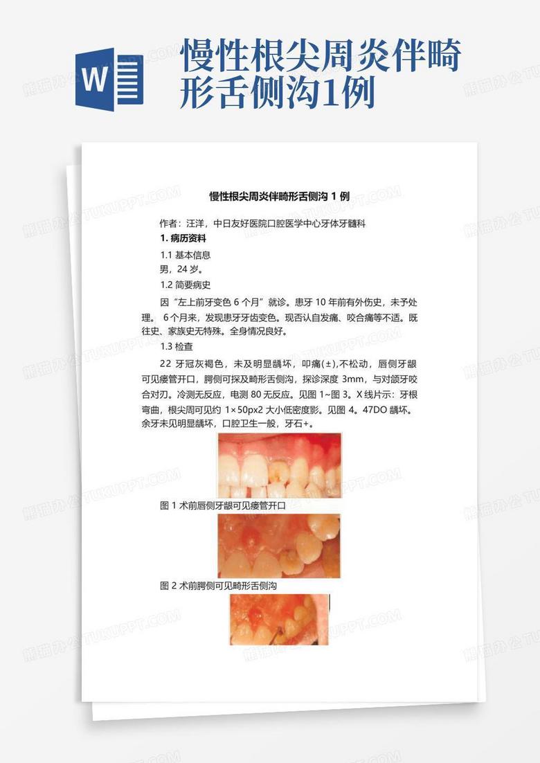 慢性根尖周炎伴畸形舌侧沟1例Word模板下载 编号lzgbxrvn 熊猫办公