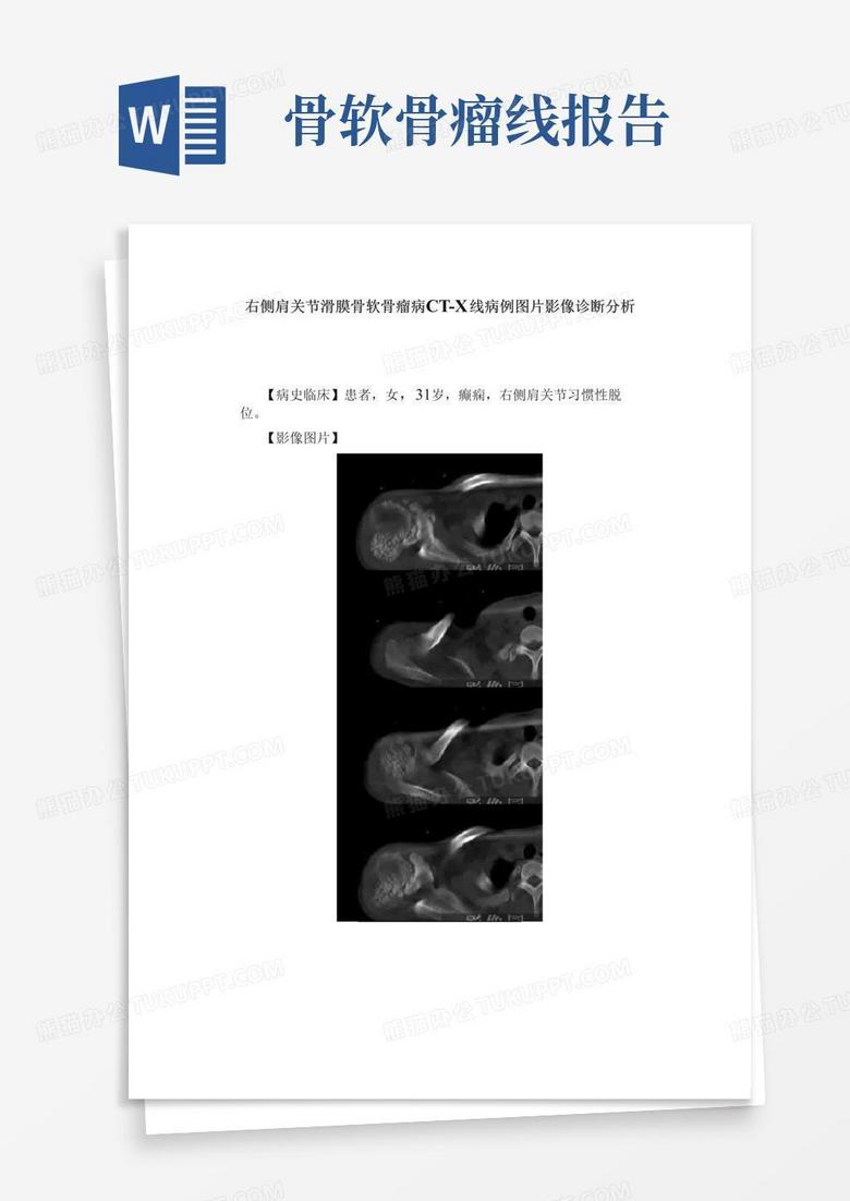 右侧肩关节滑膜骨软骨瘤病ct-x线病例图片影像诊断分析Word模板下载_编号lzrmjpzn_熊猫办公
